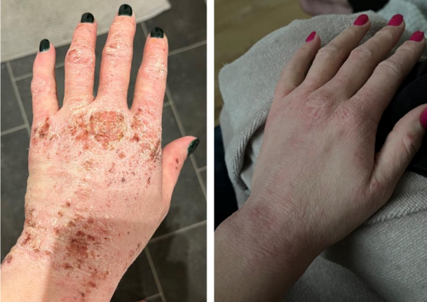 Hyperbaric Oxygen Therapy may be the secret cure to treat Topical ...